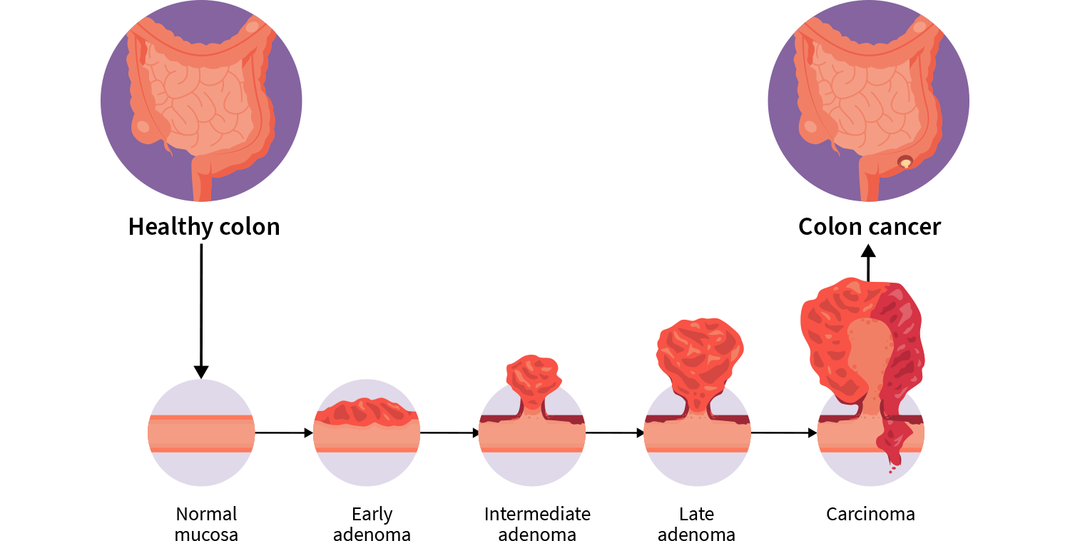 Can green tea help prevent colon cancer? - Study Summary - Examine